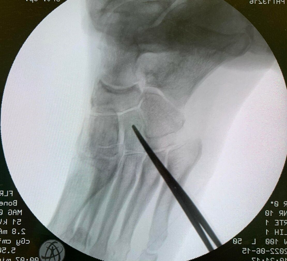 BEHANDLING AV DROPPFOT ETTER SKADE AV NERVUS PERONEUS - Kirurgen